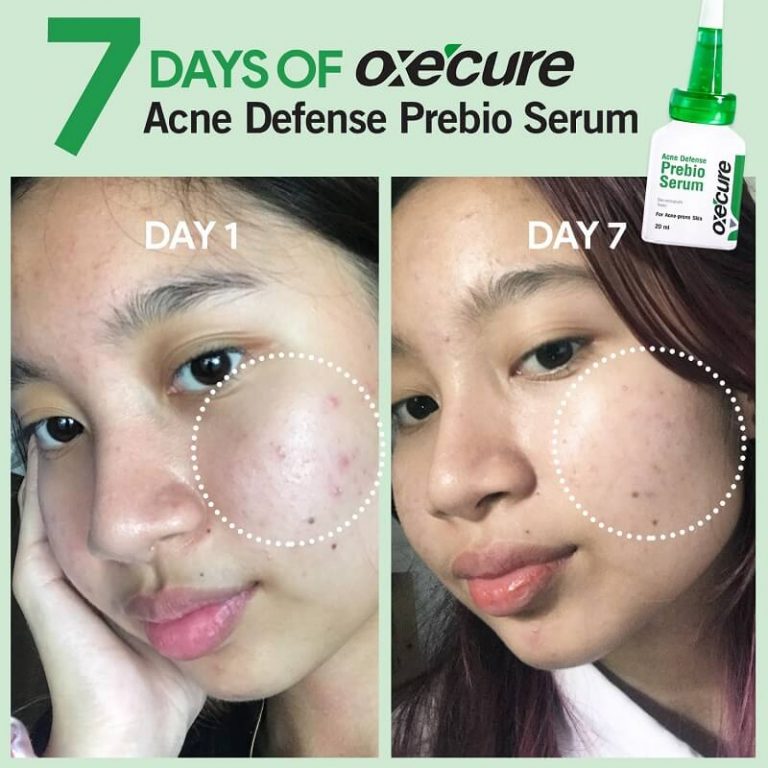 Oxe Cure Acne Defense Prebio Serum - Thailand Best Selling Beauty ...