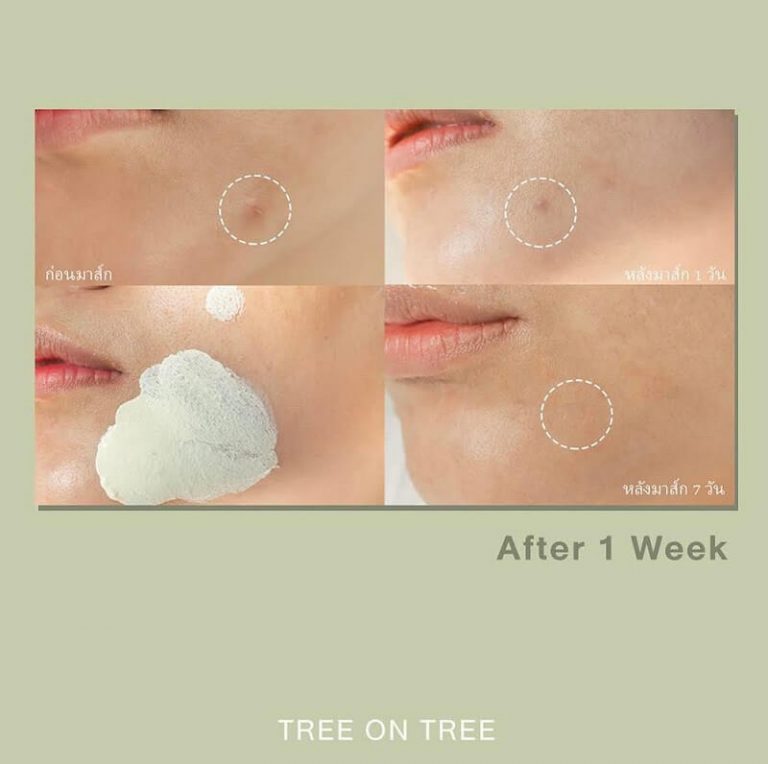 Tree On Tree Organic Acne Mask - Thailand Best Selling Beauty Products ...